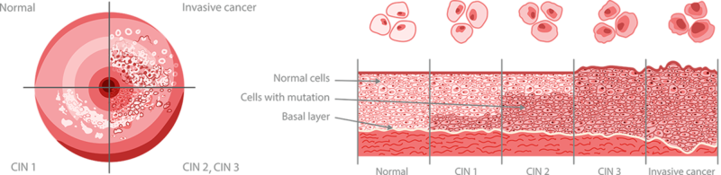 Cervical Cancer - Transcriptome AI Analysis